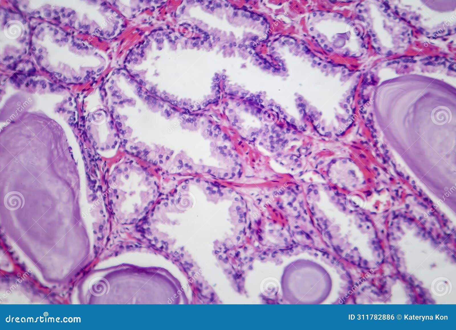 Benign Prostatic Hyperplasia, Light Micrograph Stock Photo - Image of ...