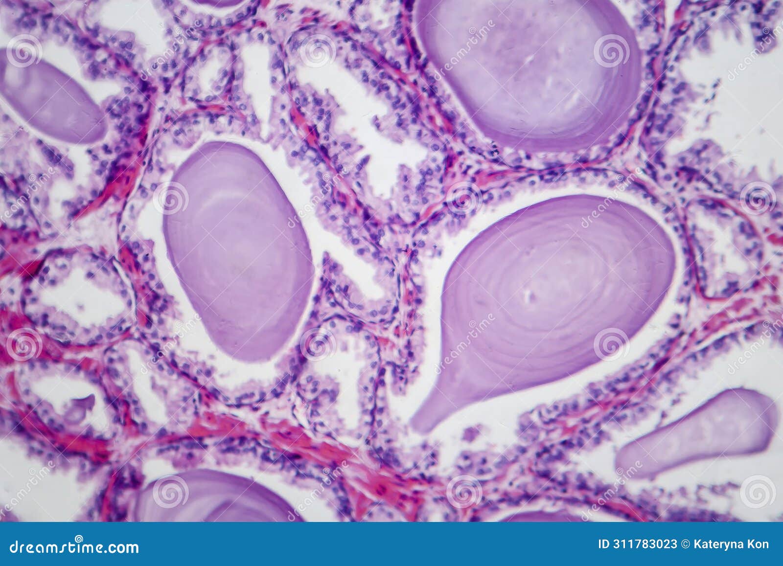 Benign Prostatic Hyperplasia, Light Micrograph Stock Image - Image of ...