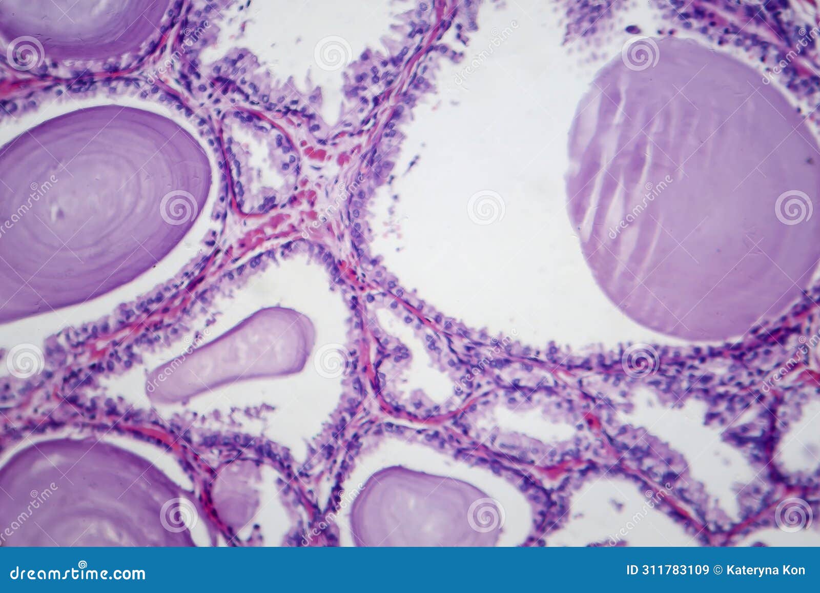 Benign Prostatic Hyperplasia, Light Micrograph Stock Image - Image of ...