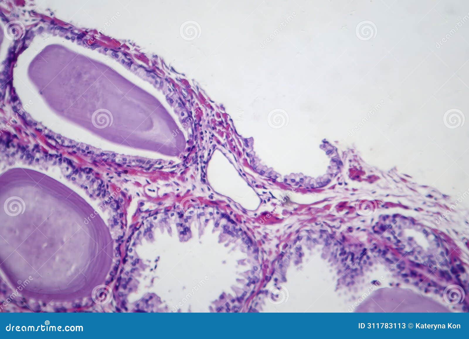 Benign Prostatic Hyperplasia, Light Micrograph Stock Image ...