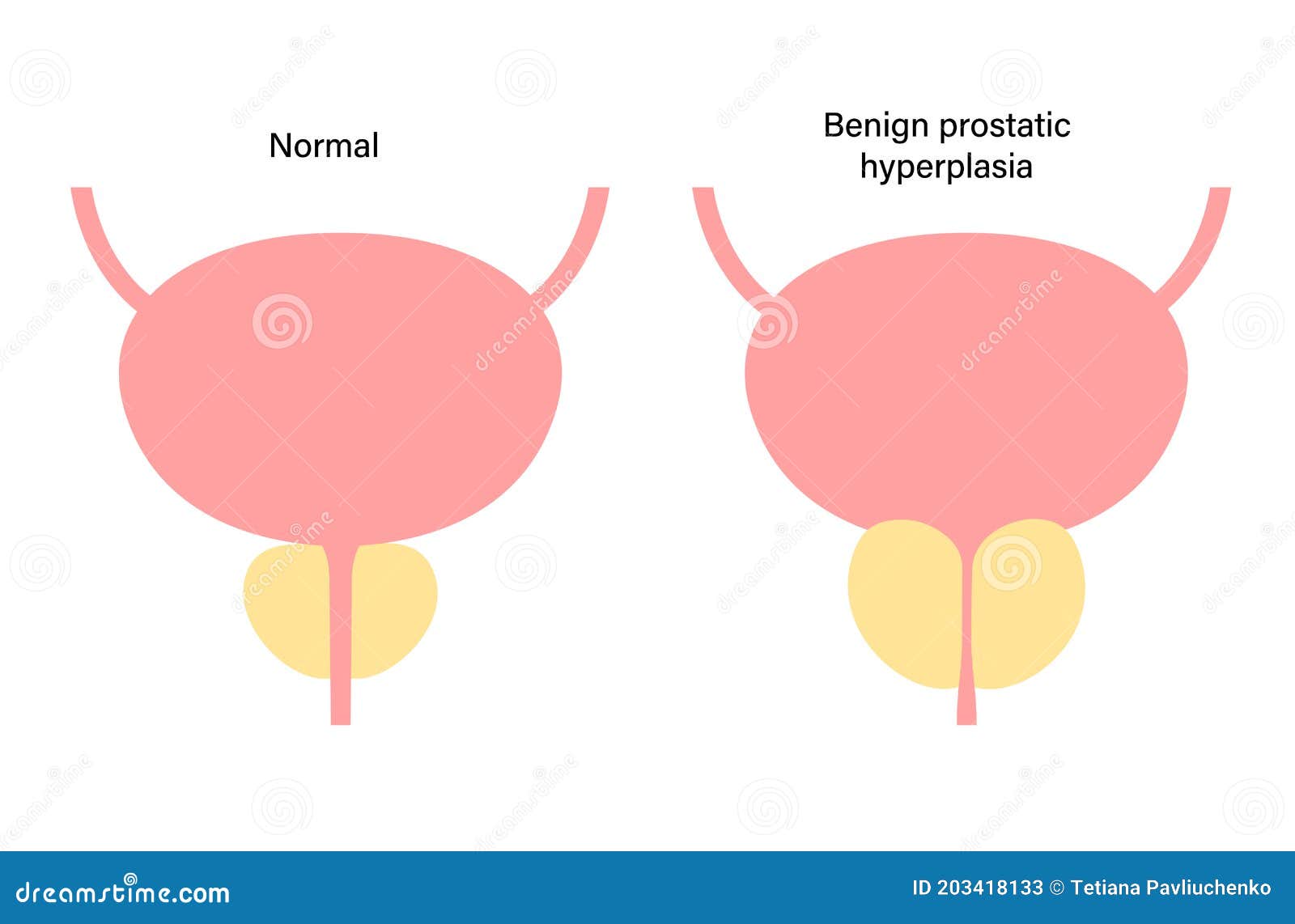 BPH info concept stock vector. Illustration of clinic - 203418133