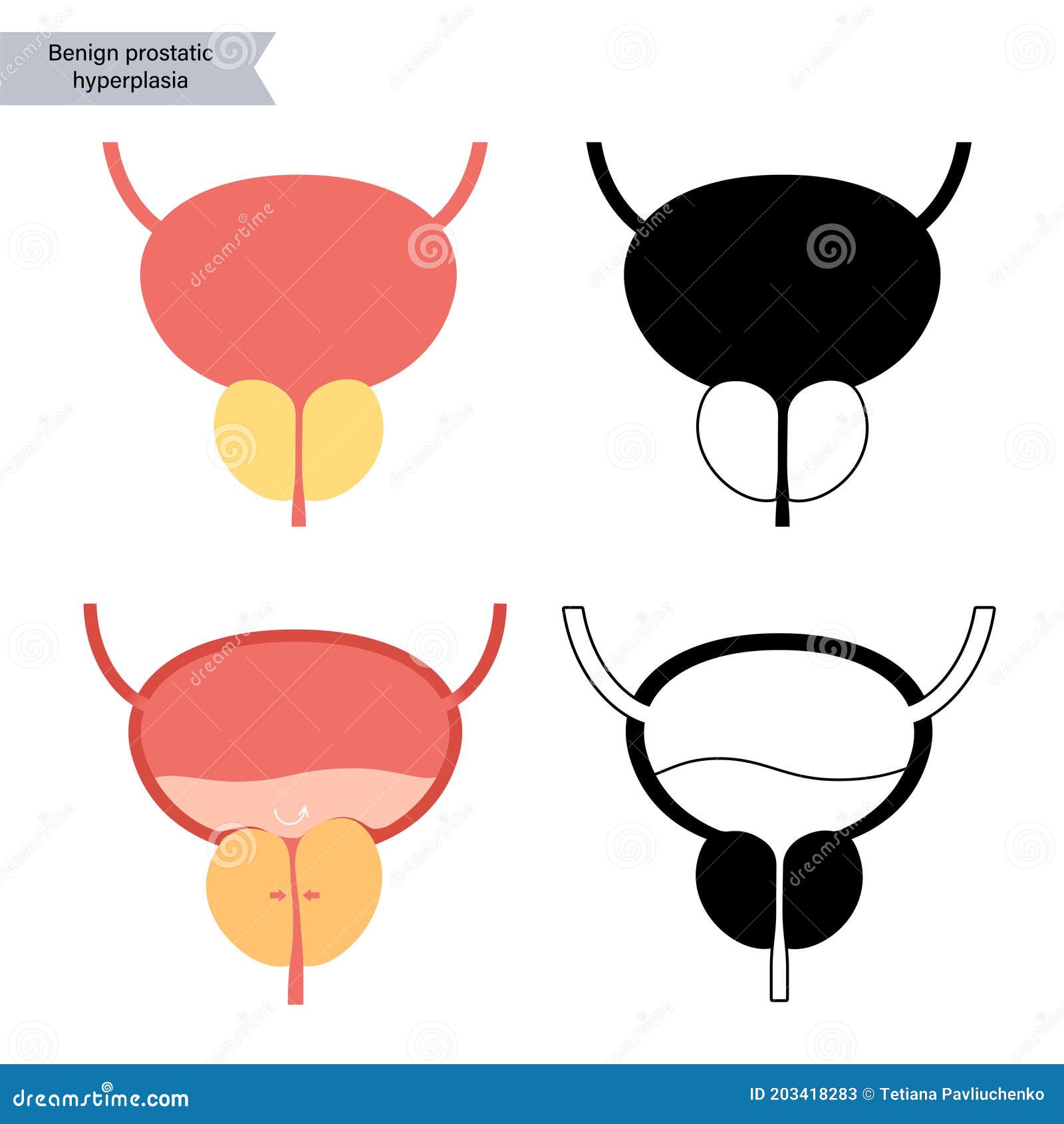 BPH info concept stock vector. Illustration of health - 203418283