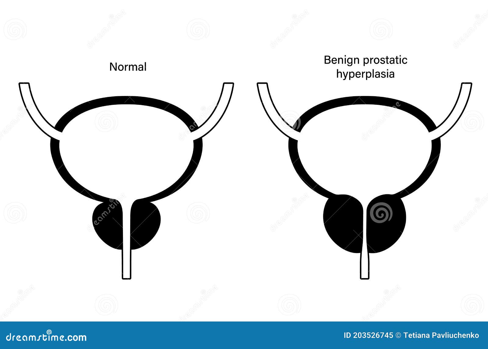 BPH info concept stock vector. Illustration of icon - 203526745