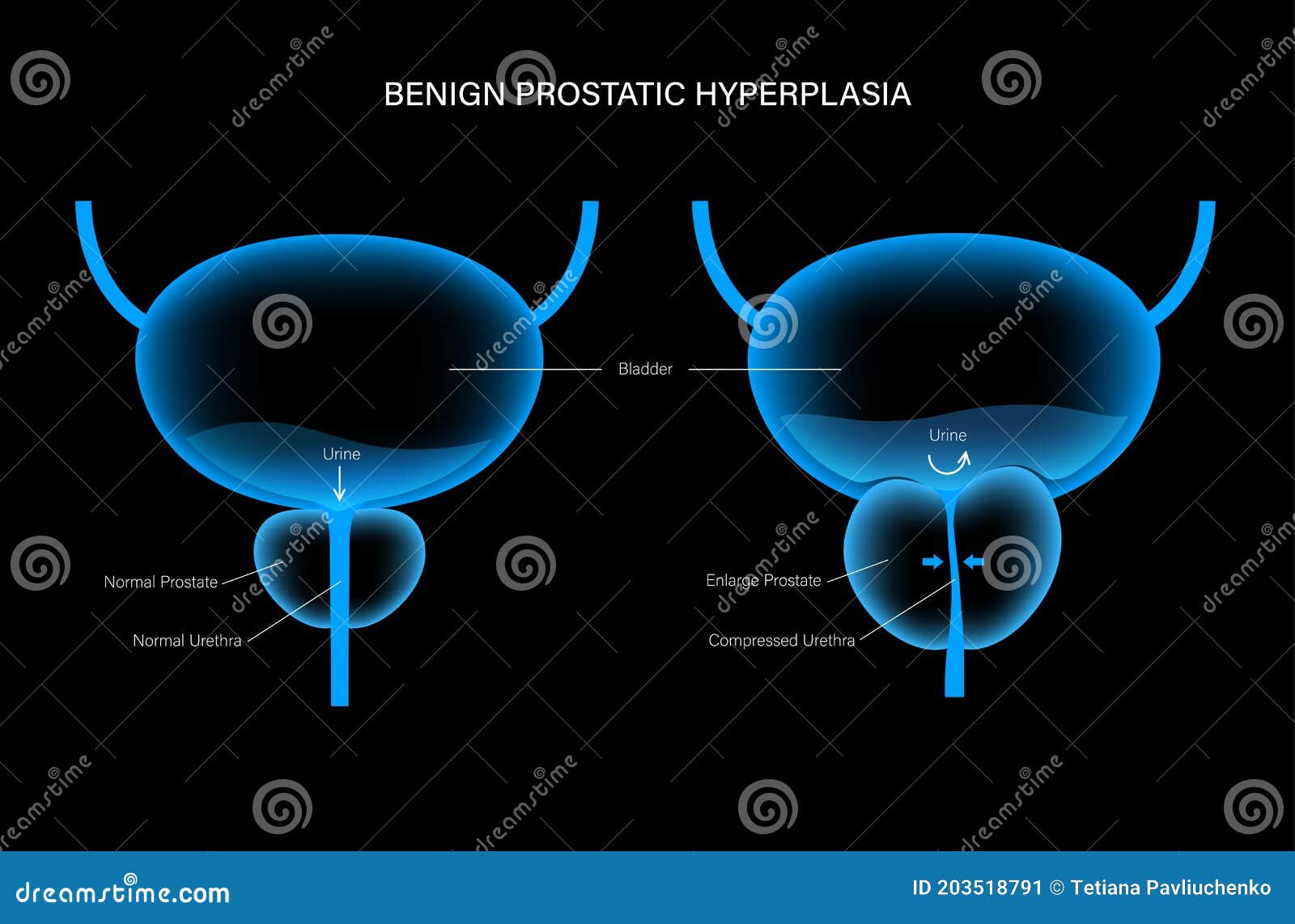 BPH Info Concept Cartoon Vector | CartoonDealer.com #203518791