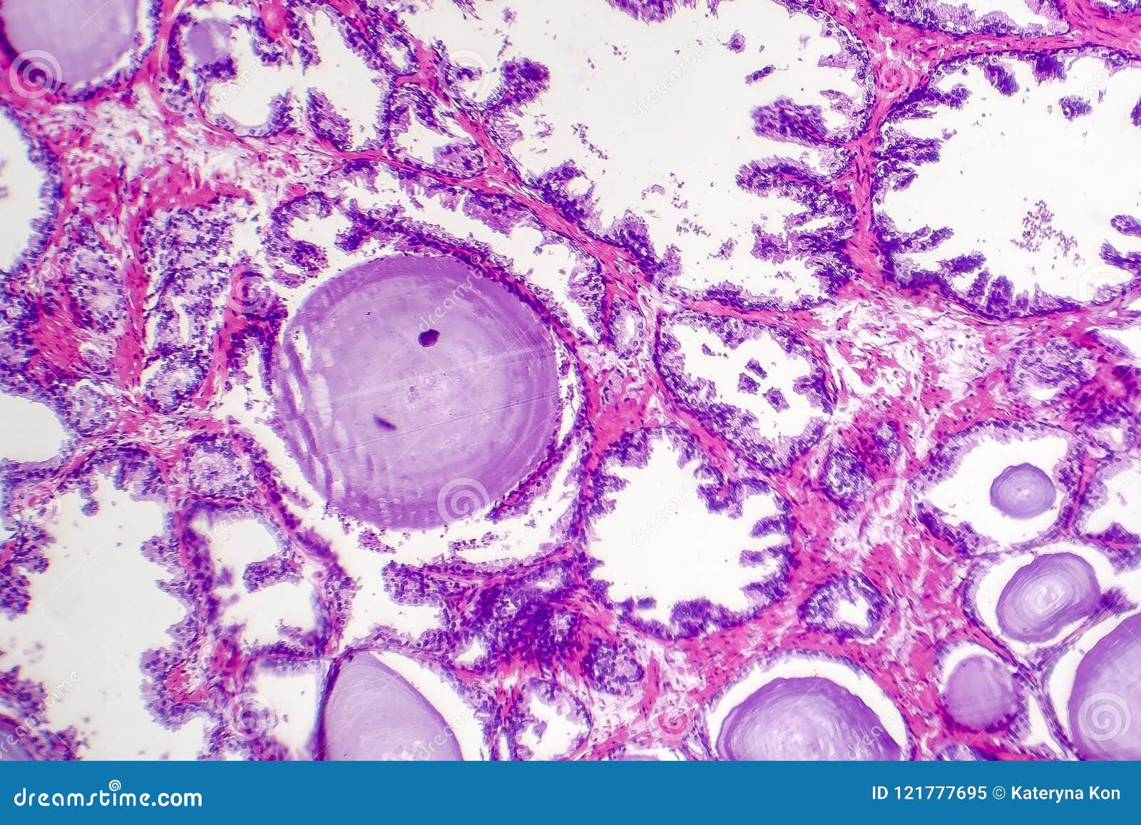 Benign Prostatic Hyperplasia Stock Image - Image of morphology, cell ...
