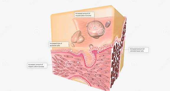 Benign Prostatic Hyperplasia in Prostatic Tissue Stock Illustration ...
