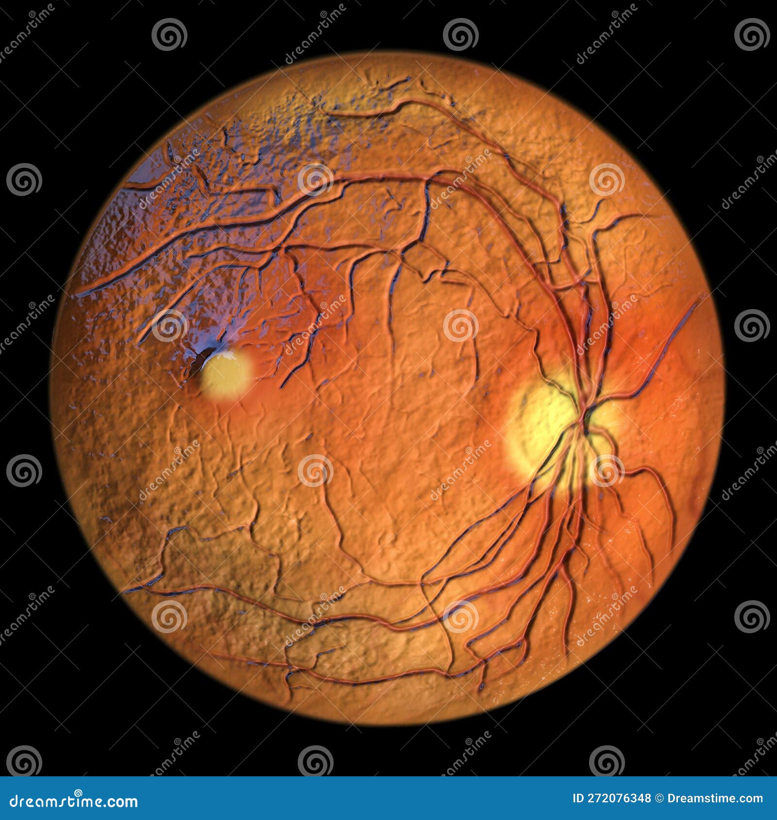 Best Vitelliform Macular Dystrophy, Vitelliform Stage, Classic Egg-yolk ... Best Vitelliform Macular Dystrophy, Vitelliform Stage, Classic Egg-yolk ...
