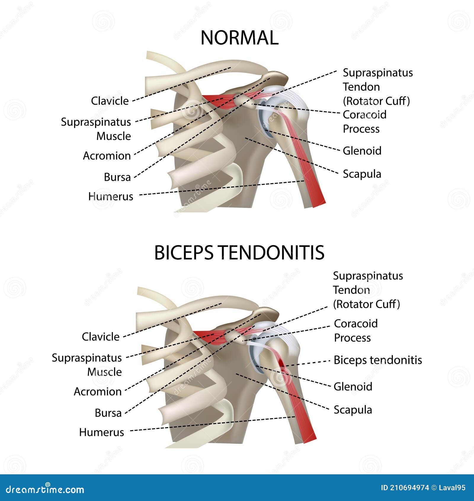 Biceps Tendonitis, Shoulder Joint, Realistic Vector Illustration Stock ...