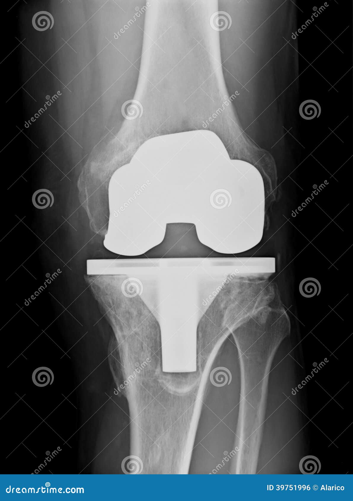 Bicompartmental Knee Prosthesis Xray Stock Photo - Image of surgery ...