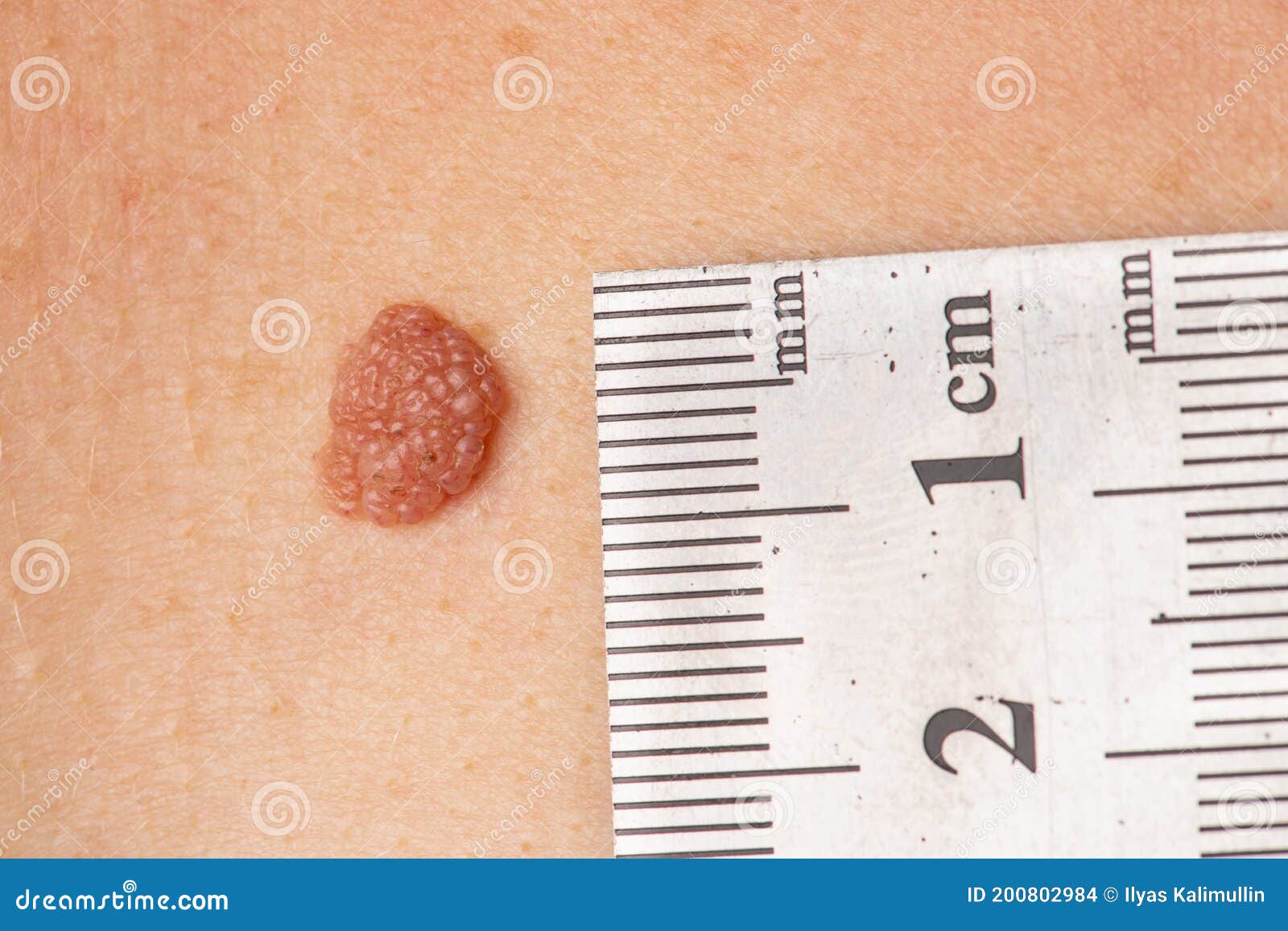 Big mole with mm ruler stock photo. Image of mole, millimeter - 200802984