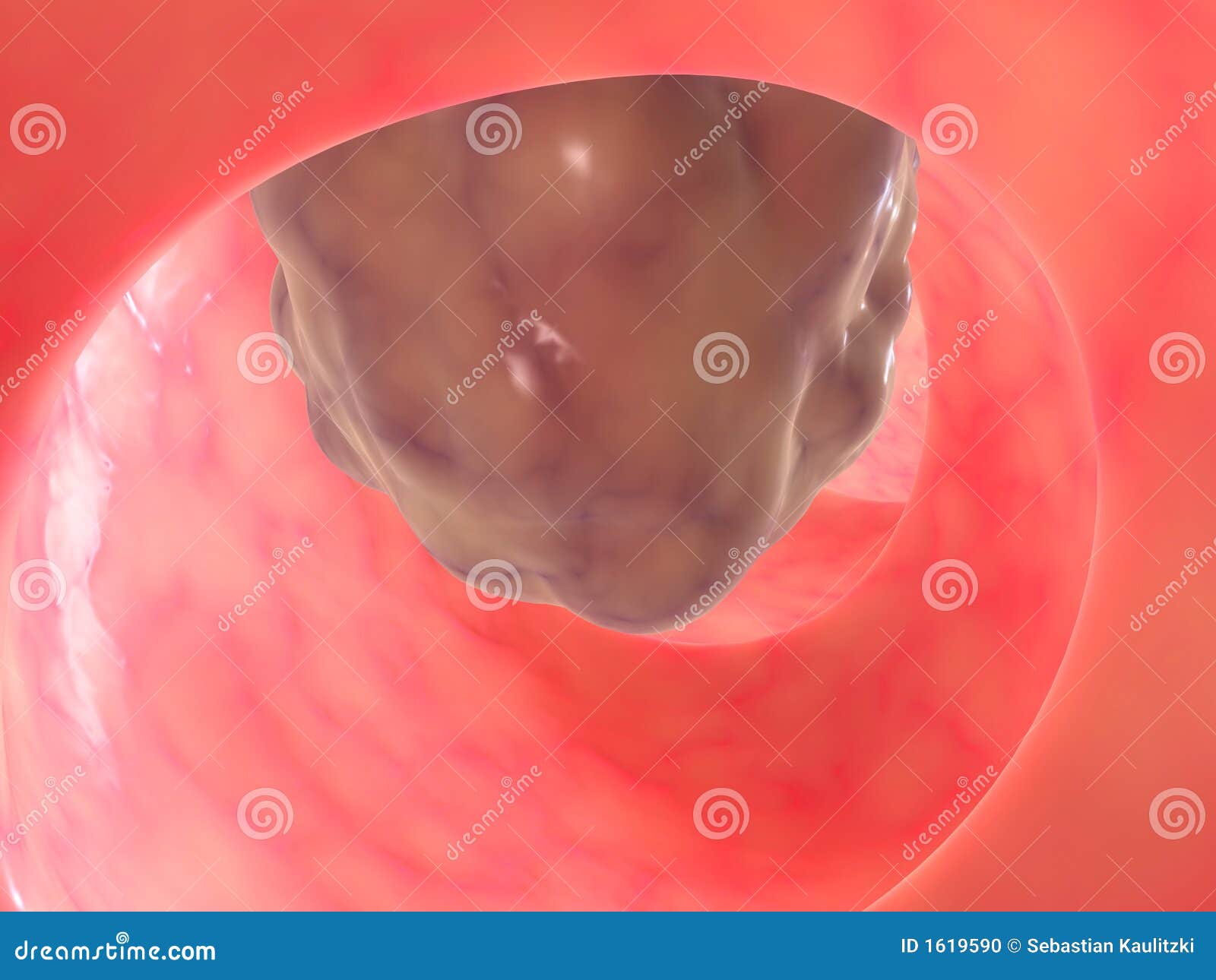 Big bowel polyp stock illustration. Illustration of cell - 1619590