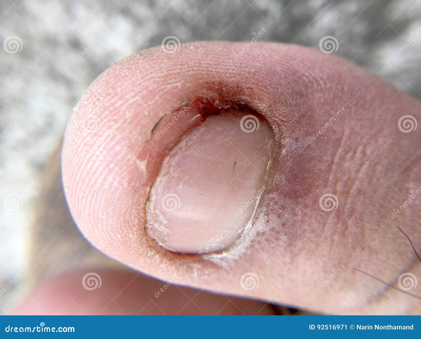 Damaged toenail stock image. Image of infection, ingrown - 92516971
