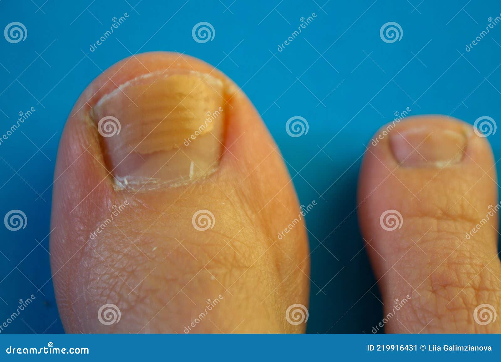 Big toe nail stock image. Image of toenail, nail, fungal - 219916431