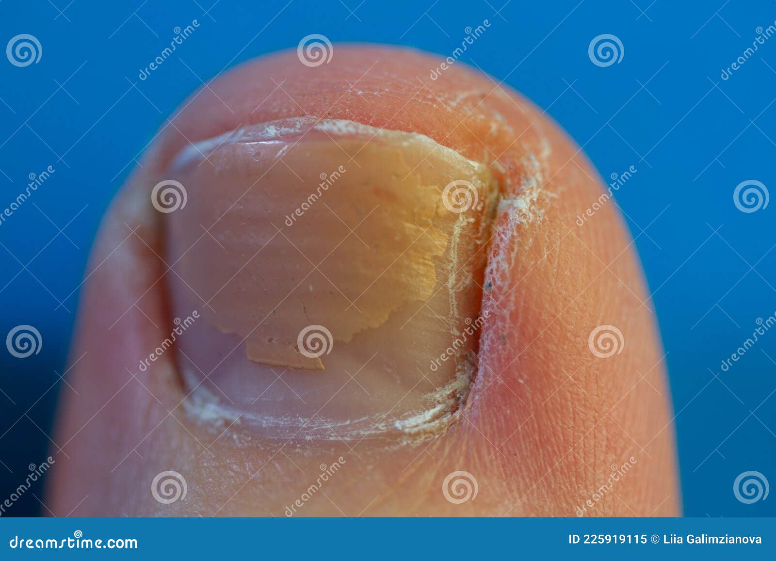 Big toe nail stock image. Image of pedicure, disease - 225919115