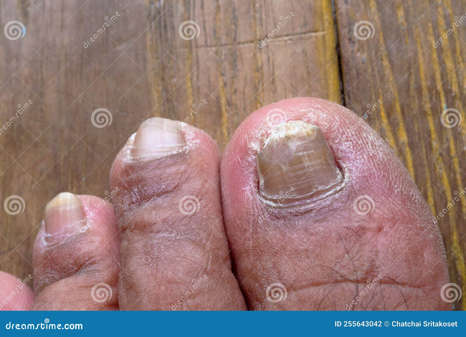 Big Toe Nails are Fungal Disease Stock Photo - Image of adult, human ...