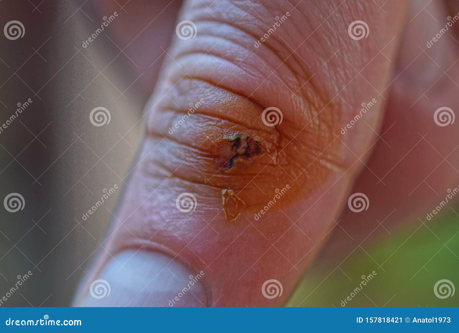 Big Wound on the Gray Skin of the Finger Stock Image - Image of injured ...