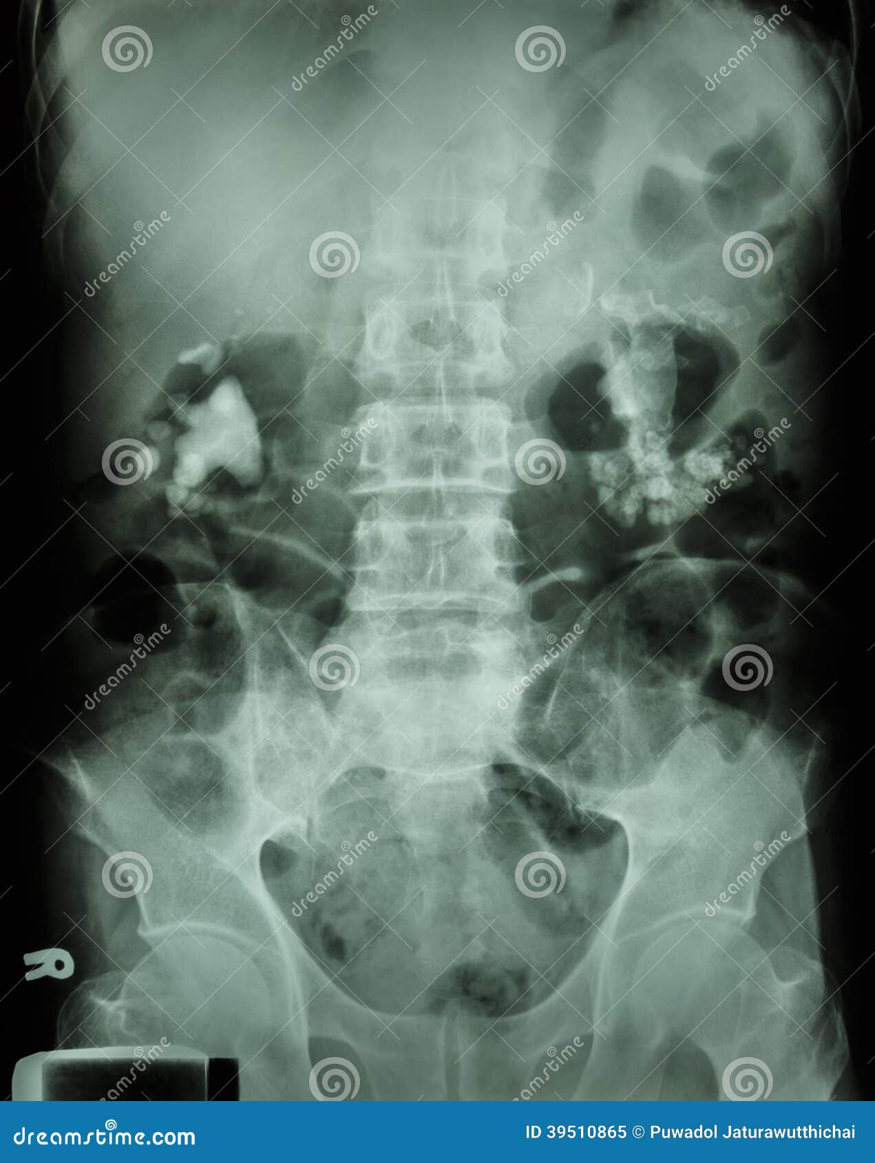 Diagnosis Nephrolithiasis Photo. Figure Of Kidney Lies Next To ...