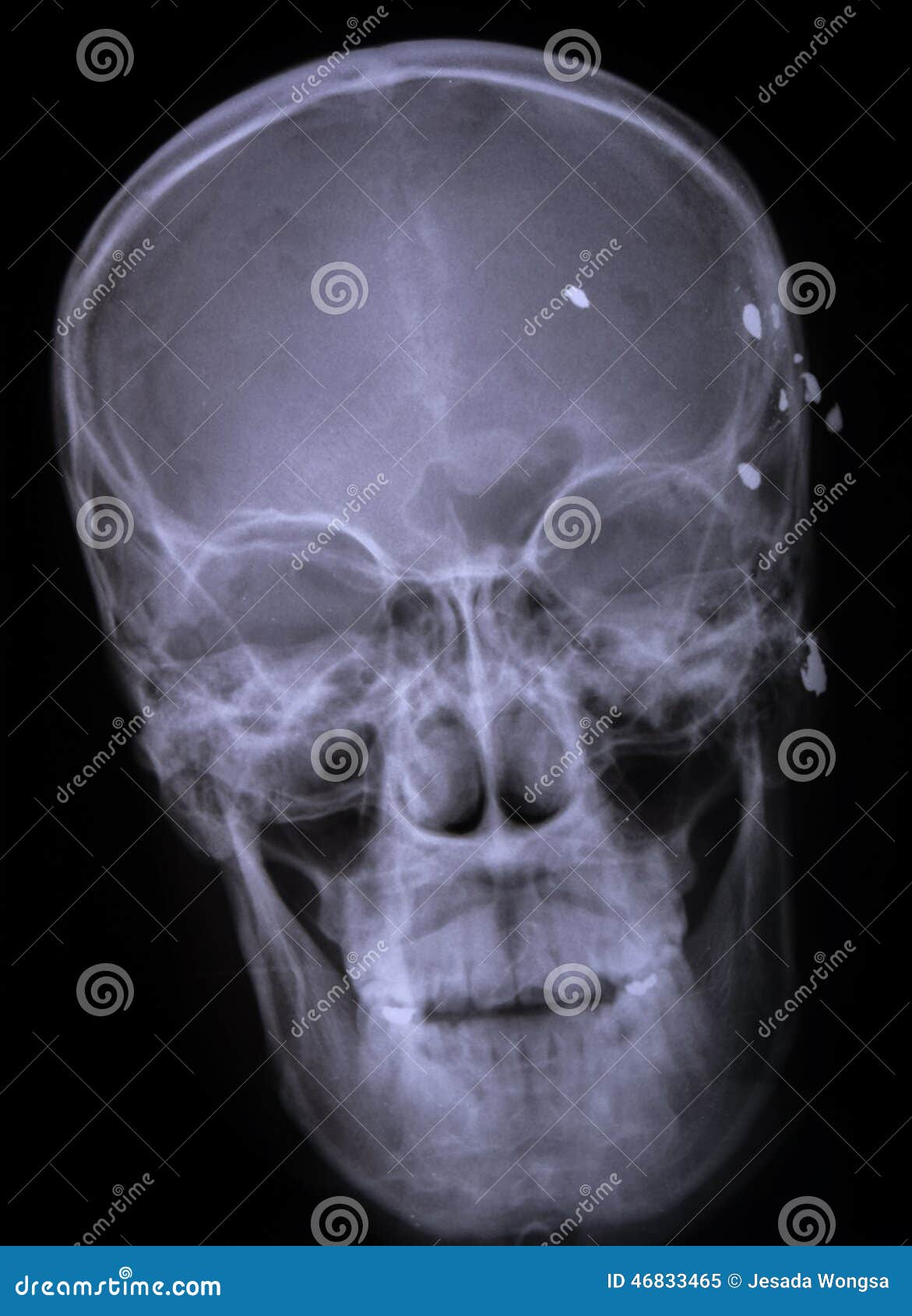 Bild Des Strahls X Einer Kugel Vom Gewehr Im Kopf Stockbild - Bild von ...