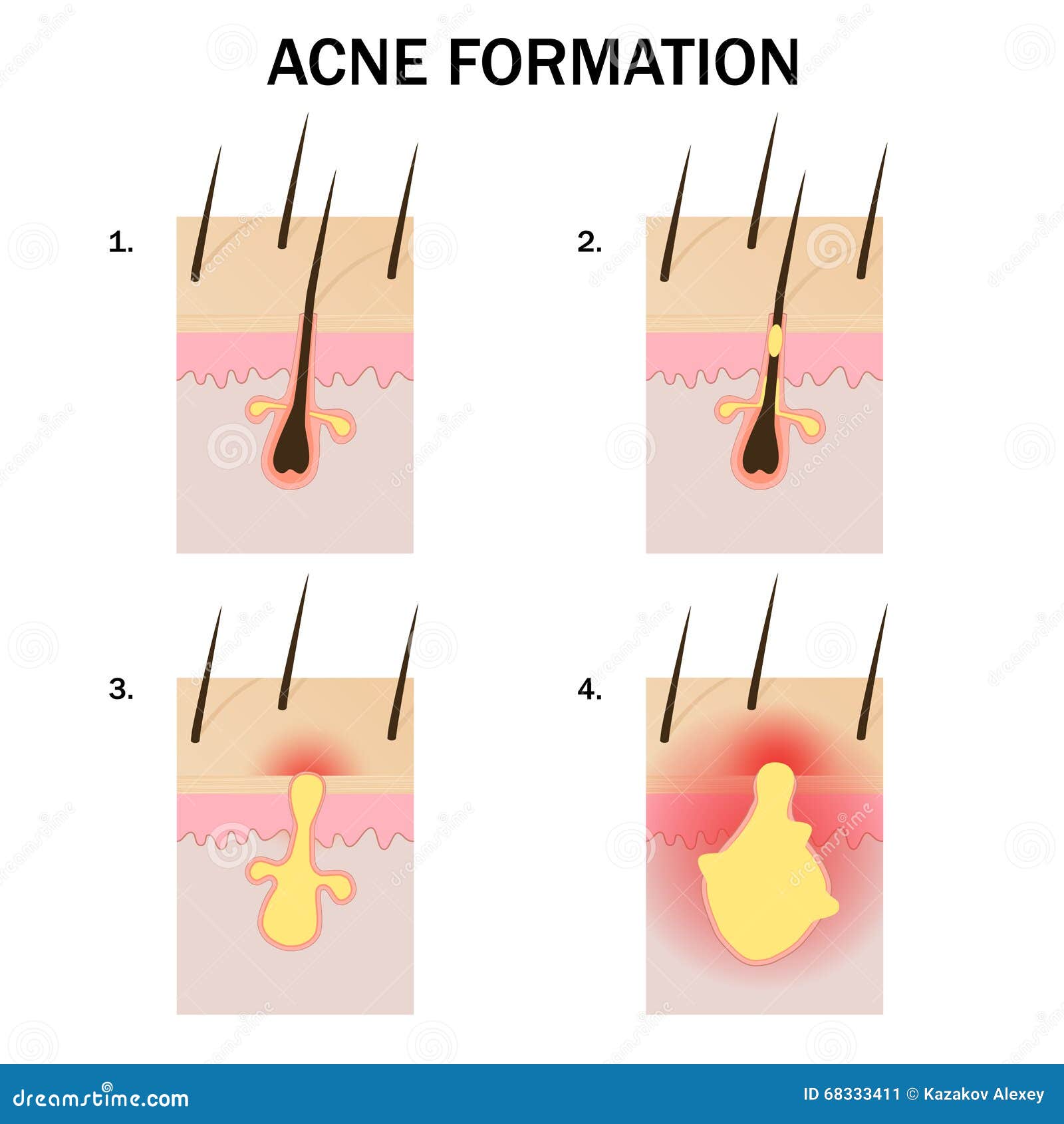 Bildung der Akne vektor abbildung. Illustration von physiologie - 68333411