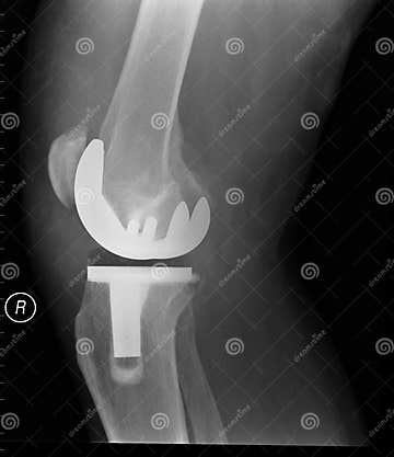 Bionic Knee stock photo. Image of disease, help, bones - 4724238