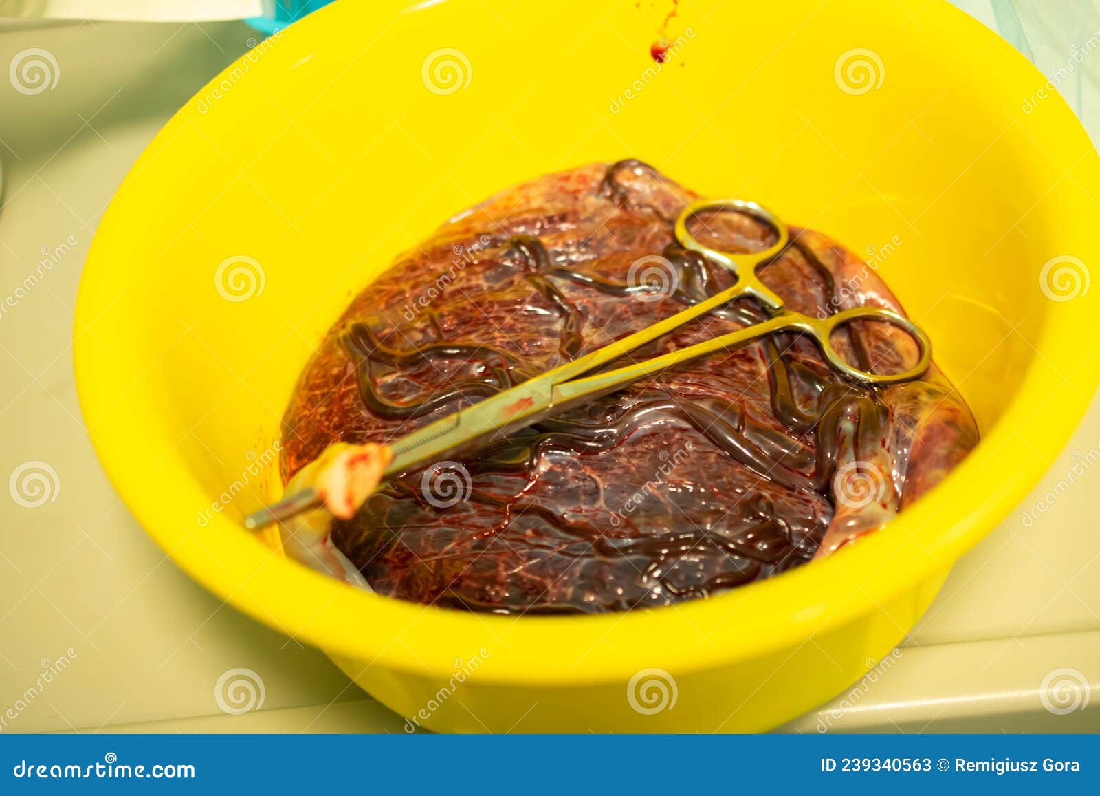 Birthing Placenta in a Bowl with a Clamp Stock Image - Image of labor ...