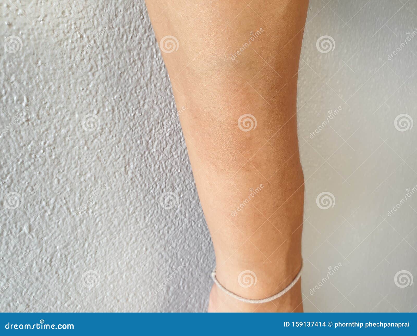 Birthmark on Arm Surface. almost Harmonious and Invisible Stock Photo ...