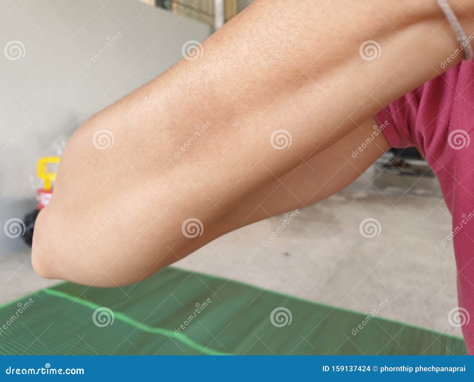 Birthmark on Arm Surface. almost Harmonious and Invisible Stock Photo ...