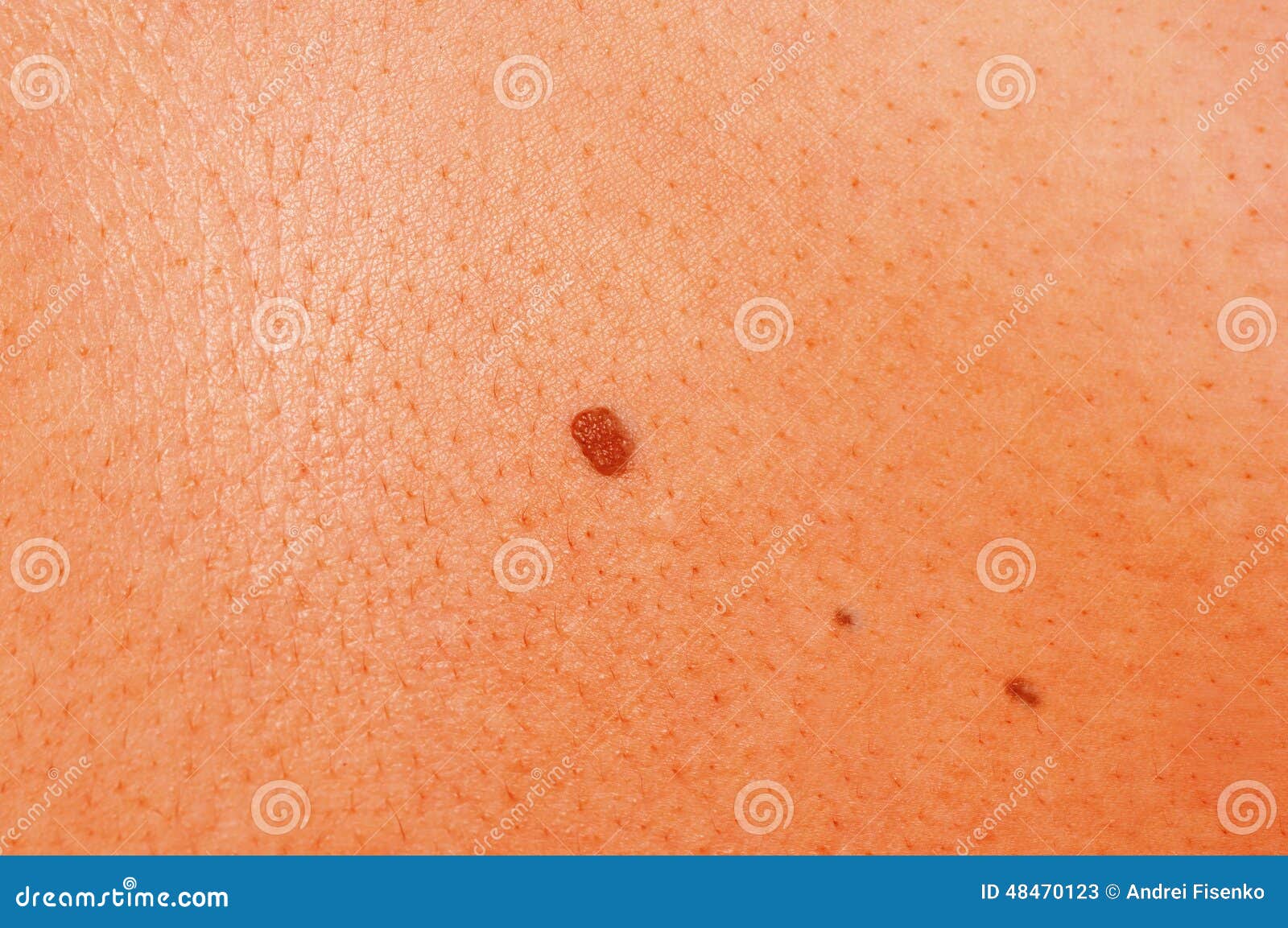 Birthmark on the body stock image. Image of adults, medicine - 48470123