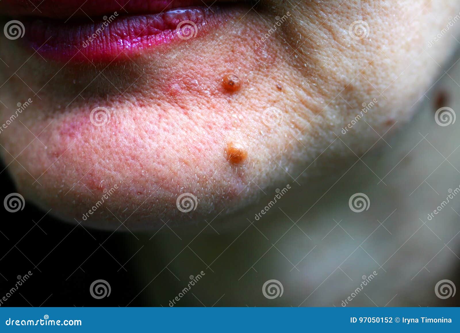 Birthmark on His Chin. a Mole on the Skin of the Face. Stock Photo ...