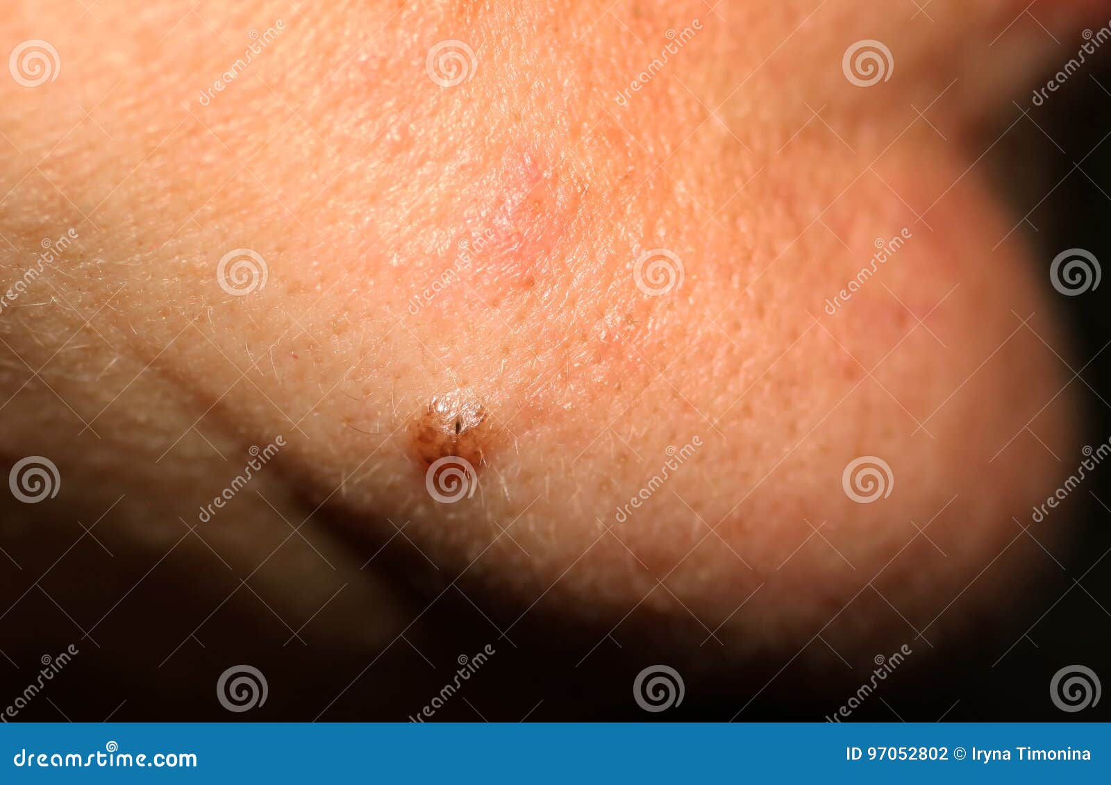 Birthmark on His Chin. a Mole on the Skin of the Face. Stock Photo ...
