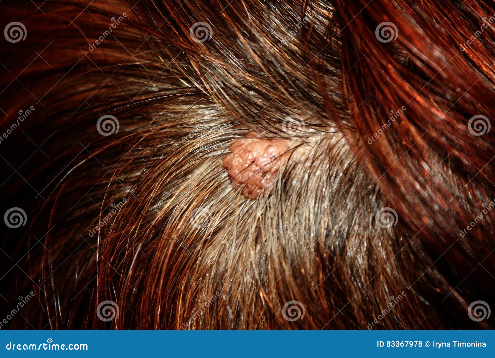 The Birthmark on His Head in Her Hair Stock Photo - Image of health ...