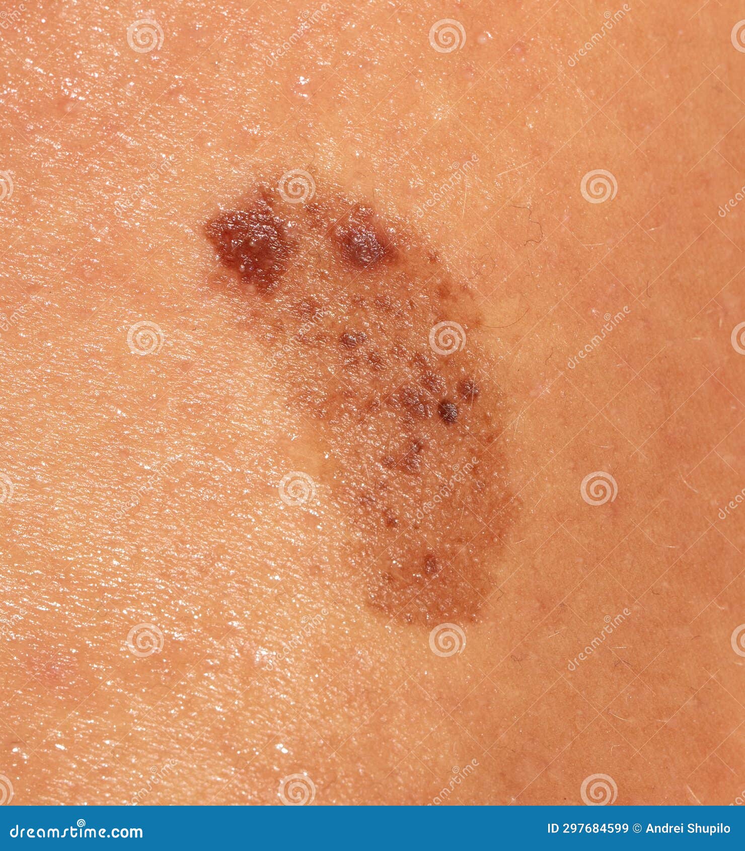 Birthmark on Human Skin. Macro Stock Image - Image of cancer ...