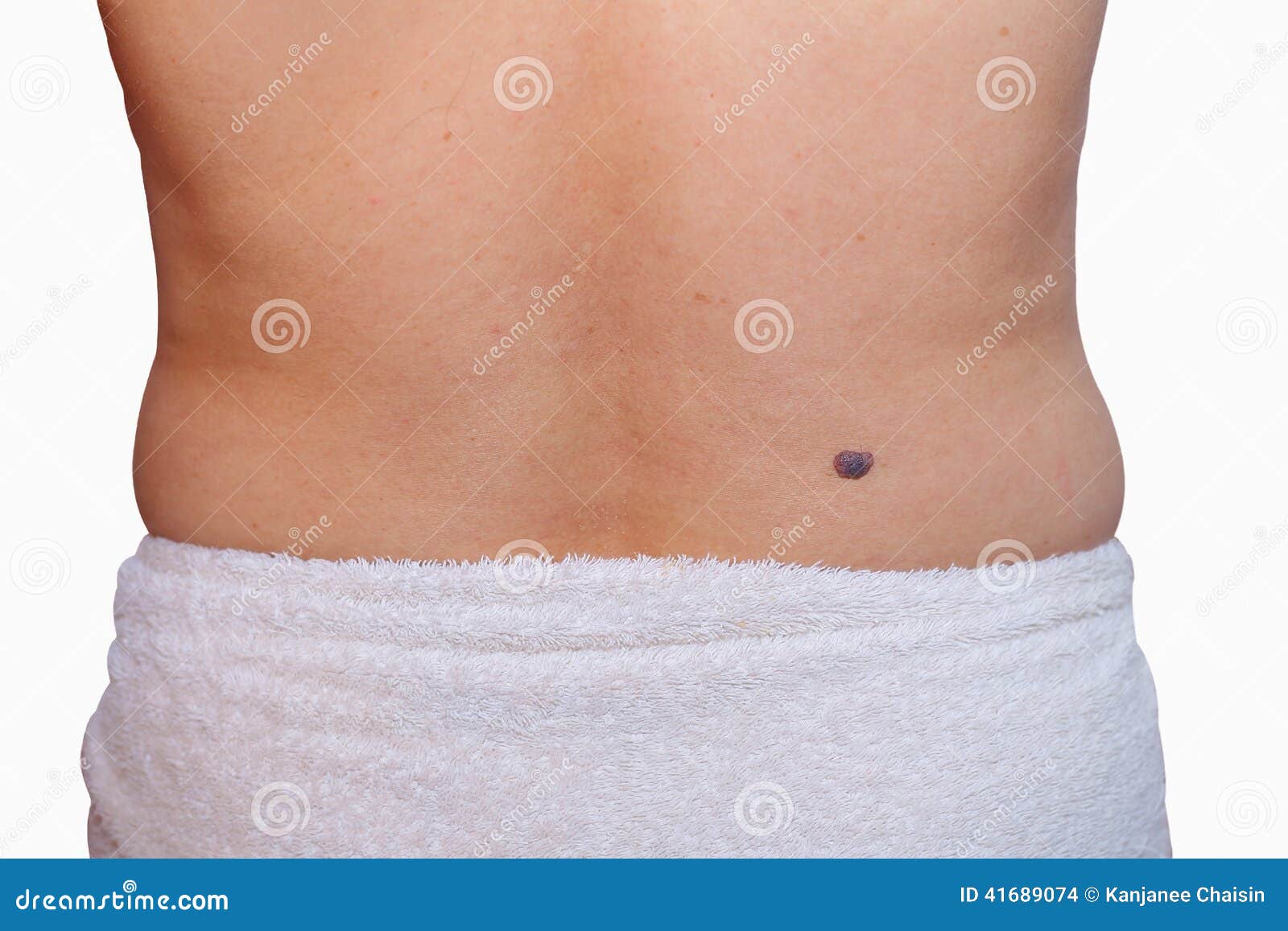 Birthmark stock photo. Image of freckle, epidermal, back - 41689074
