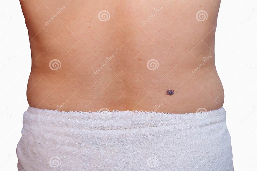 Birthmark stock photo. Image of freckle, epidermal, back - 41689074