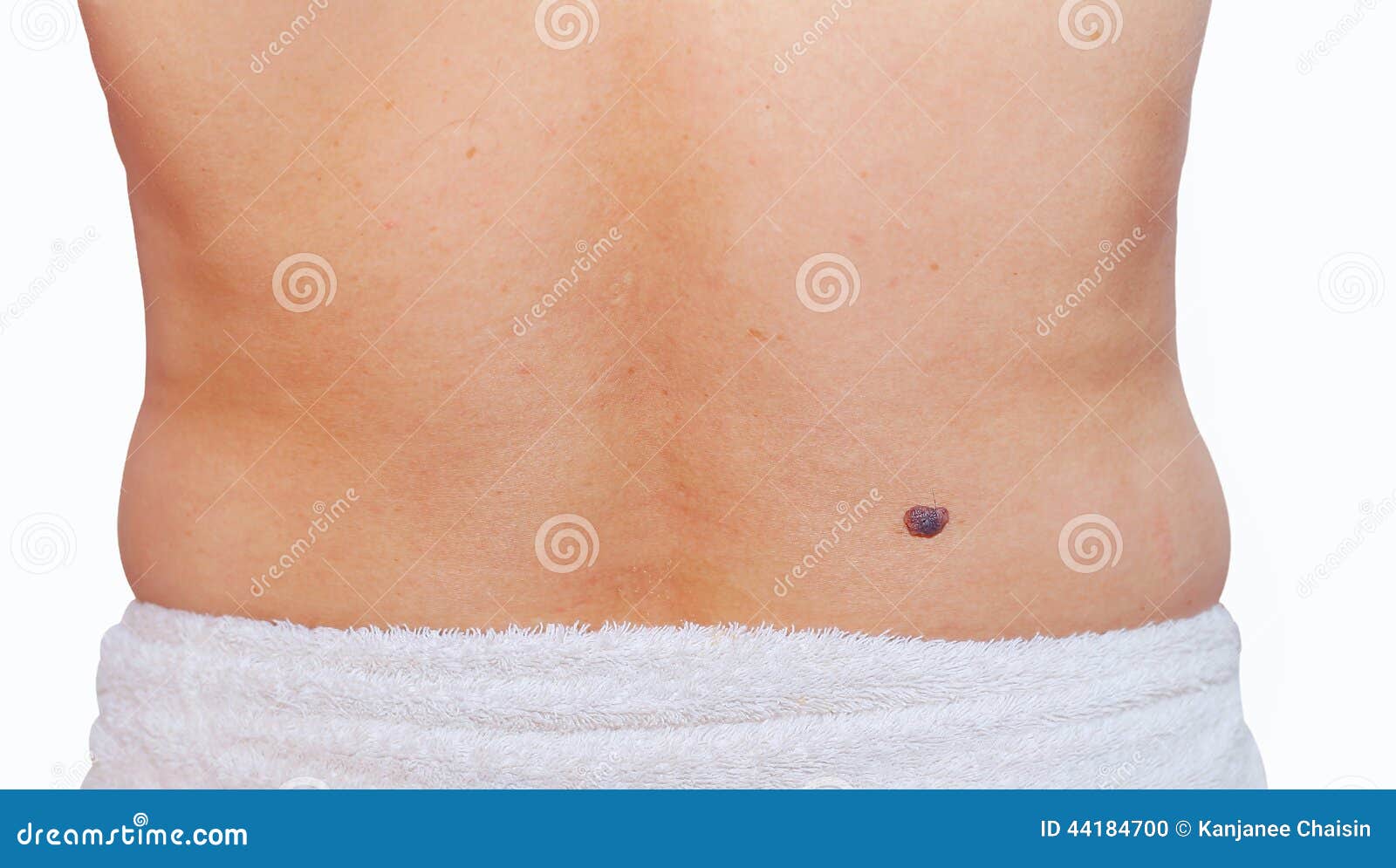 Birthmark stock photo. Image of mankind, dermatological - 44184700