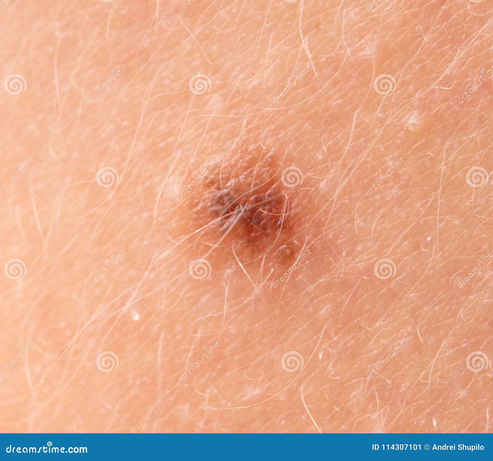 Birthmark on the Skin As a Background Stock Image - Image of cancer ...
