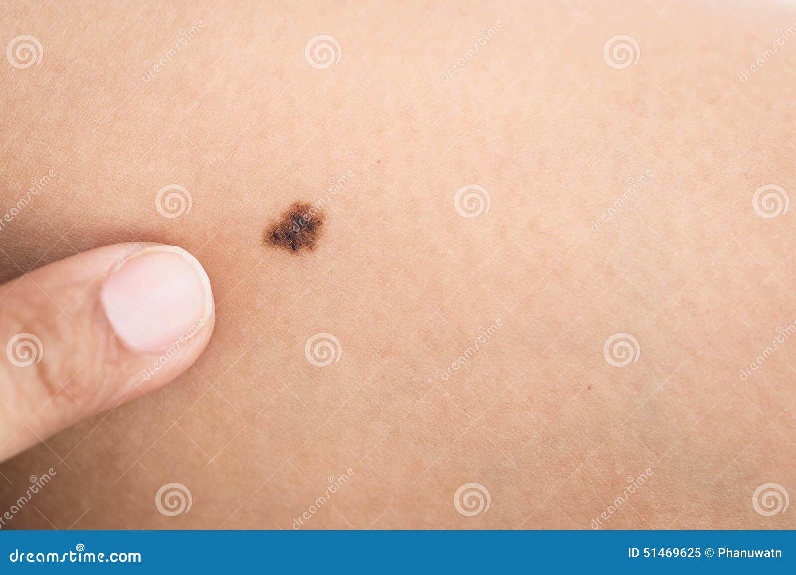 Birthmark on skin stock image. Image of biopsy, birthmark - 51469625