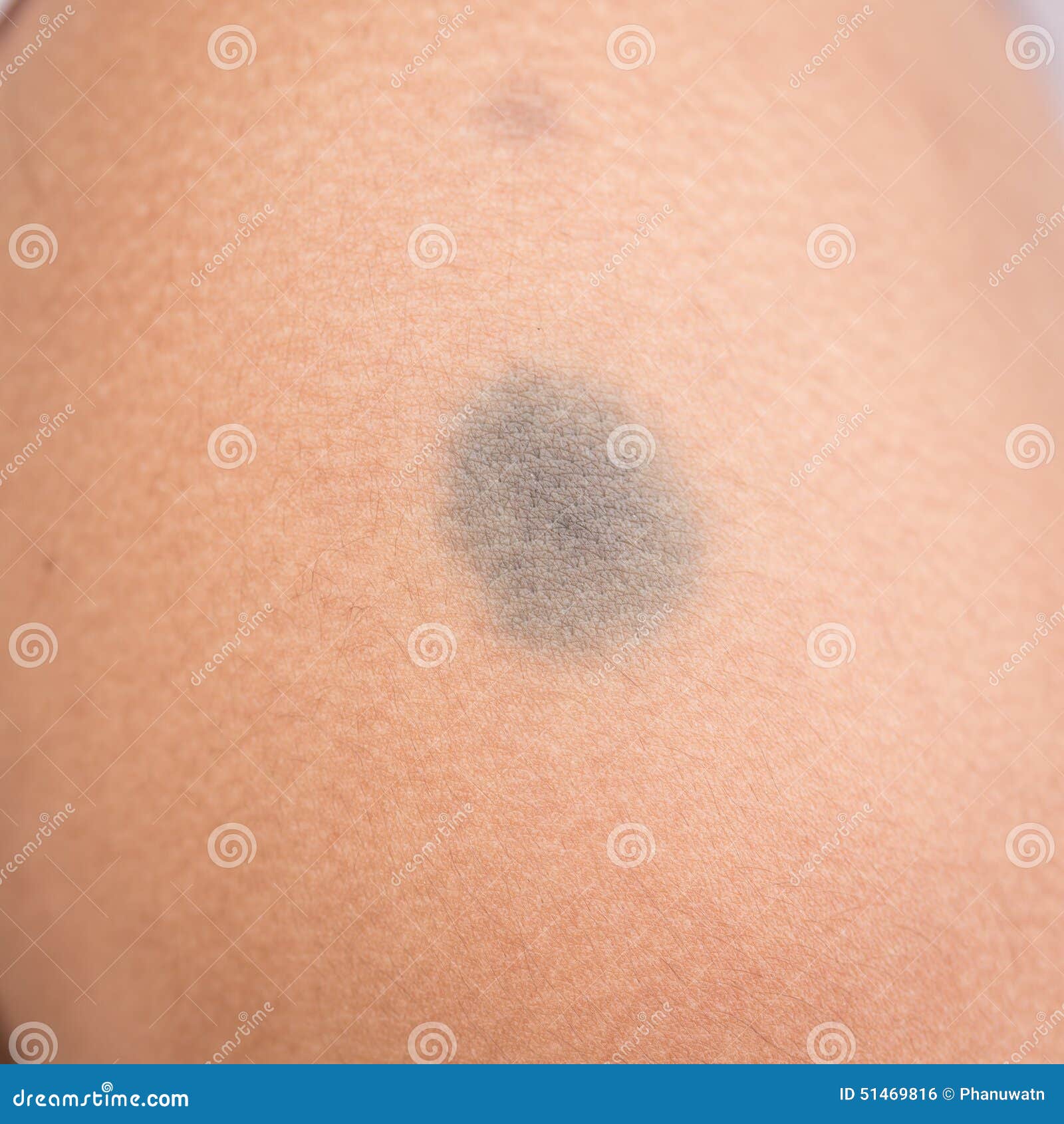 Birthmark on skin stock photo. Image of health, macro - 51469816