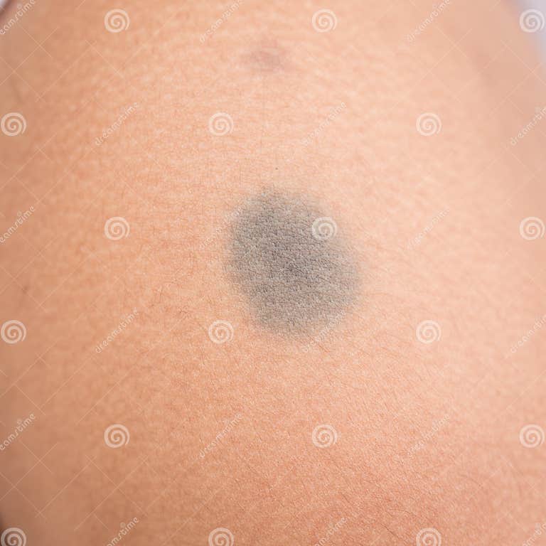 Birthmark on skin stock photo. Image of health, macro - 51469816