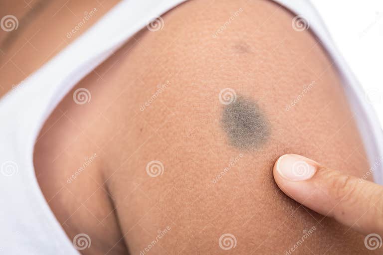 Birthmark on skin stock photo. Image of skin, lesions - 51469826
