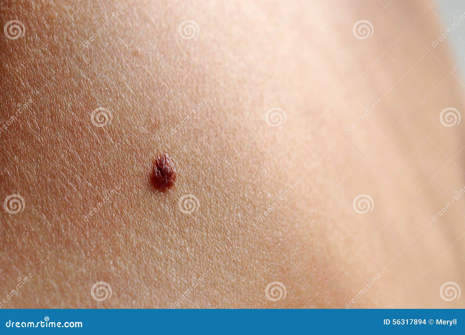 Birthmark, skin spot stock photo. Image of child, health - 56317894