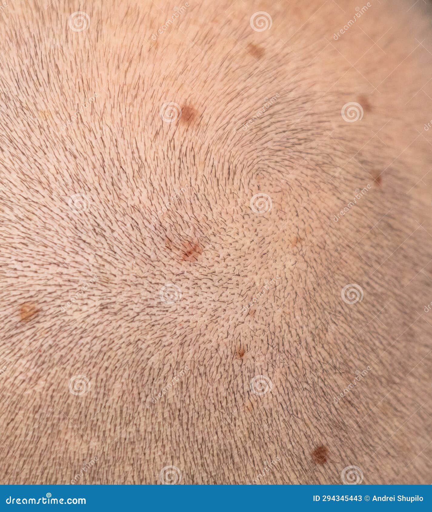 Birthmarks on a Man S Bald Head. Macro Stock Image - Image of eyebrows ...