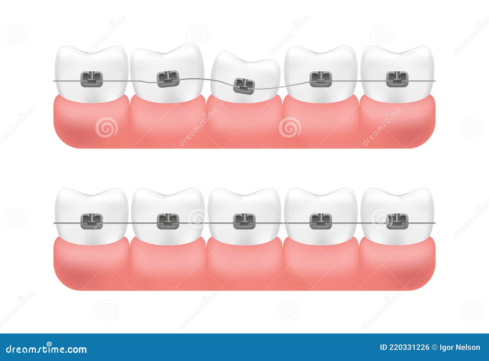 Alignment Of Teeth And Bite Correction With The Help Of Braces System ...