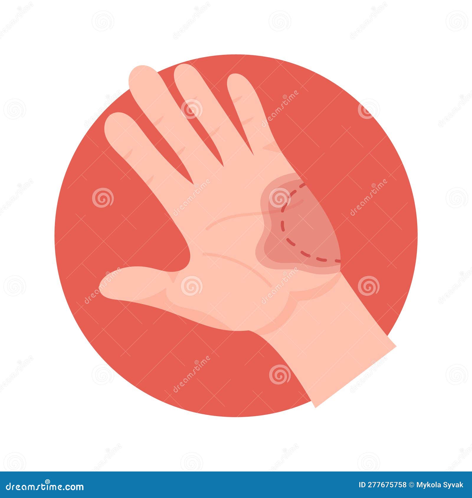 Bite on Hand Symptom stock vector. Illustration of hand - 277675758