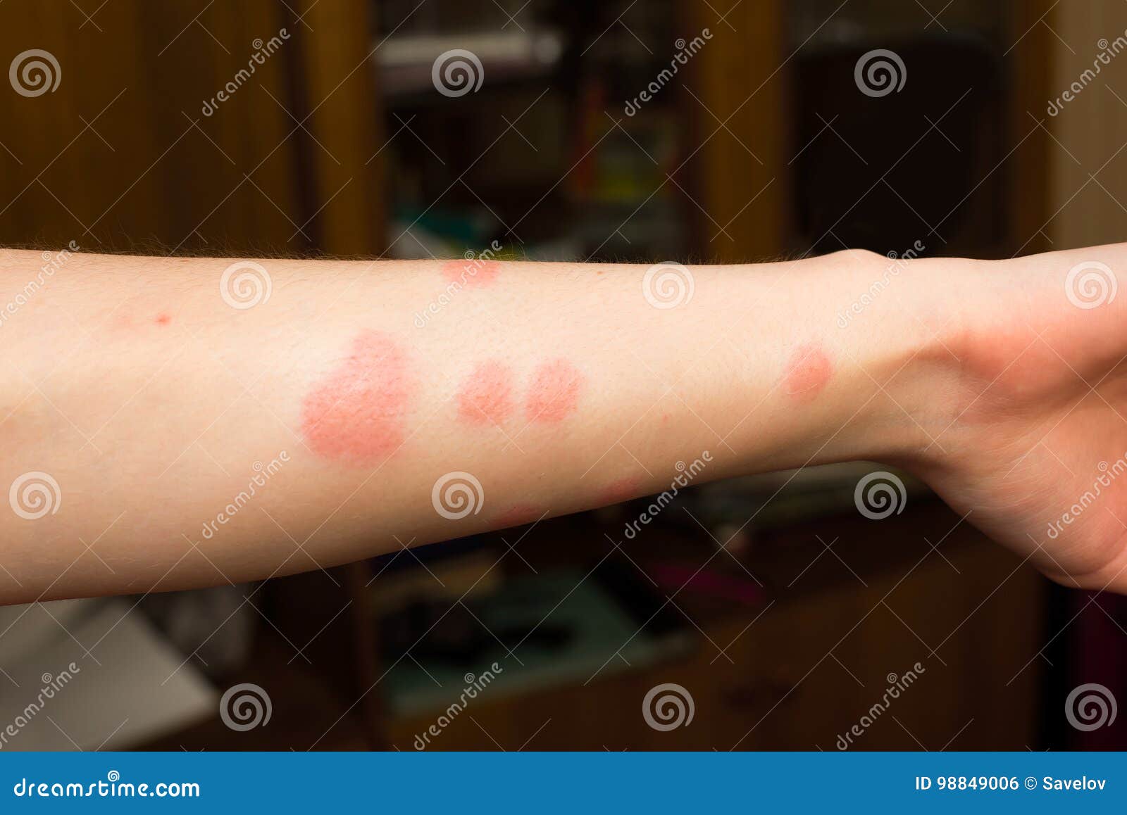 Bites from fleas stock photo. Image of dermatology, itchy - 98849006