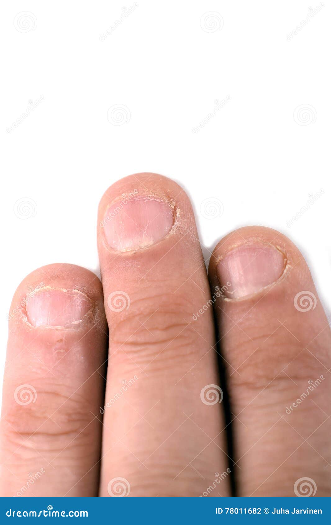 Bitten nails stock photo. Image of full, gross, hand - 78011682