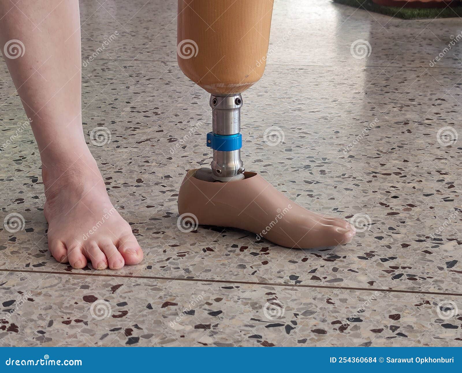 BK Disability Using and Training Leg Prothesis Stock Photo - Image of ...