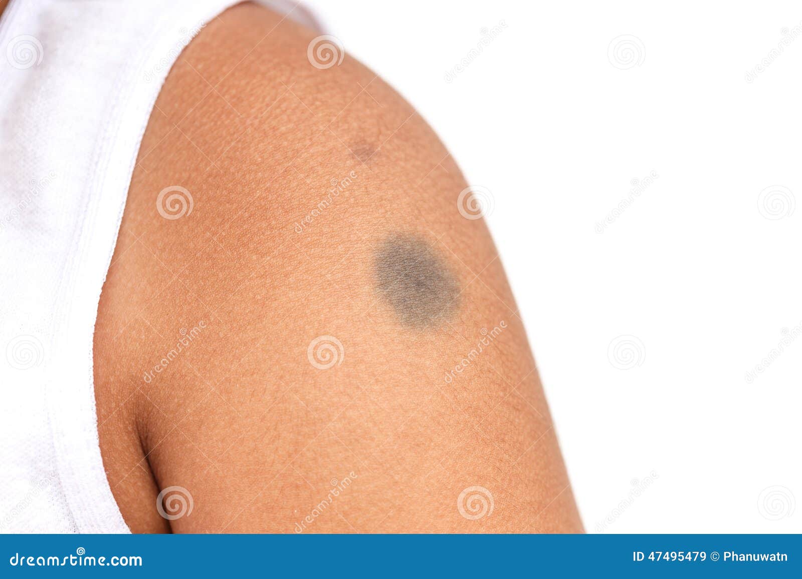 Black birthmark on skin stock image. Image of closeup - 47495479