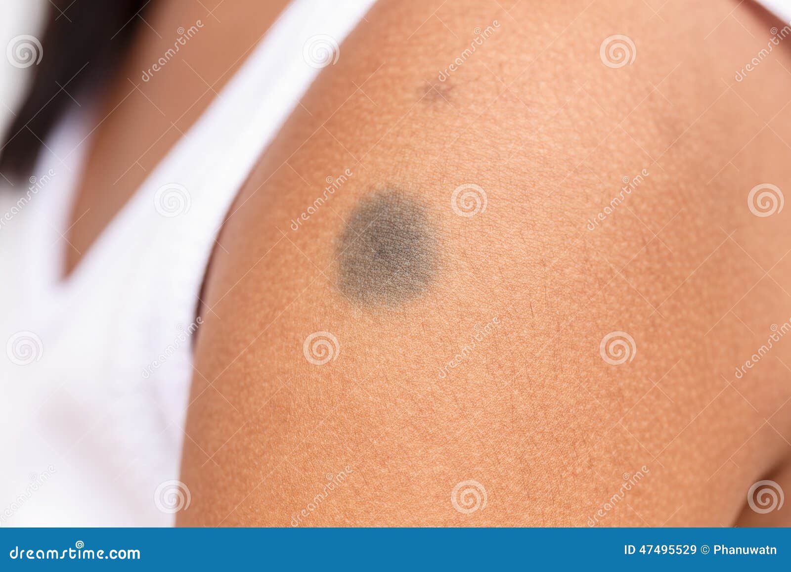 Birthmark On Skin As Background Royalty-Free Stock Photo ...