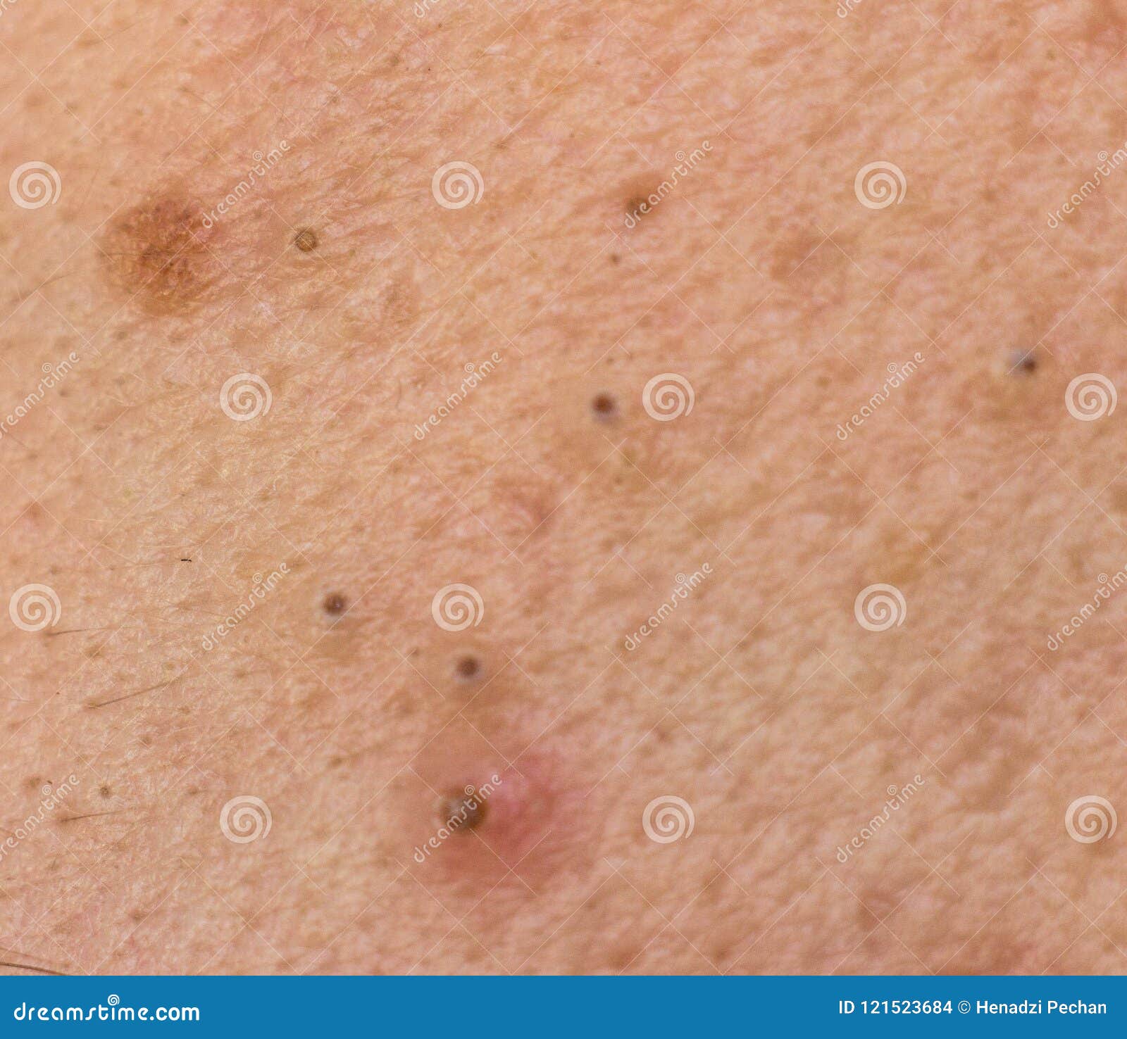 Black Dots on Face and Pimples Macro, Comedo Stock Photo - Image of ...